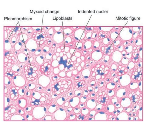 Liposarcoma Medizzy