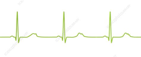Long Qt Syndrome Type 2 Electrocardiogram Illustration Stock Image