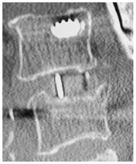 Cage Subsidence Examples Polyetheretherketone Cage Single Level Download Scientific Diagram