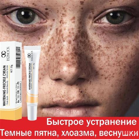 Lydimoon крем против пигментных пятен и веснушек 20 г высокоэффективный отбеливающий против