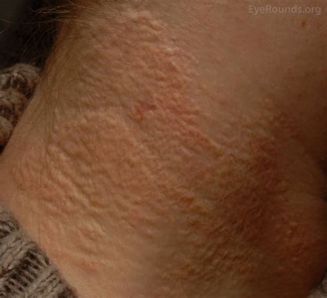 Angioid Streaks And Optic Disc Drusen In Pseudoxanthoma Elasticum The University Of Iowa