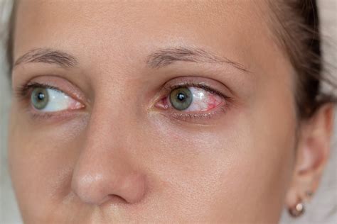 Eye Infection Top Symptoms And Effective Treatment Options