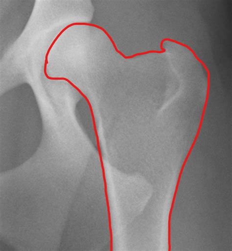 Python How To Segment Femur From X Ray In Opencv Stack Overflow