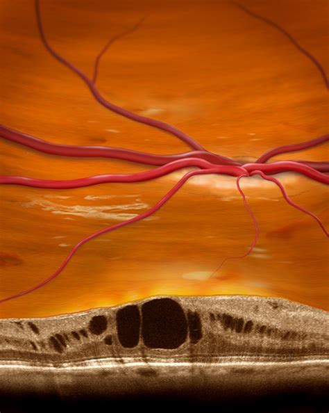 Diabetic Macular Edema Retina Perspective Art With Oct
