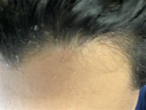 Sd Or Scalp Psoriasis R Sebderm