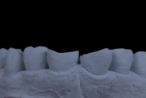 Large Class Iv Restorations