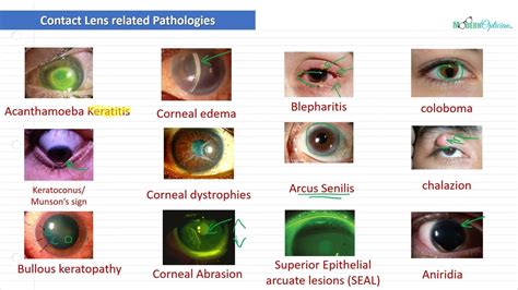 Optician Training Pathology Recognition Ocular Anatomy Lecture 28