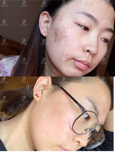 暗瘡皮膚護理：重煥肌膚光彩之路 Years 中醫美容專門店