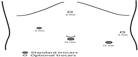 Intracorporeal Versus Extracorporeal Anastomosis For Laparos Surgical Laparoscopy Endoscopy
