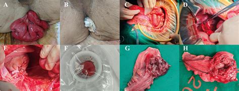 Frontiers Sudden Rupture Of Recurrent Rectal Prolapse Complicated By
