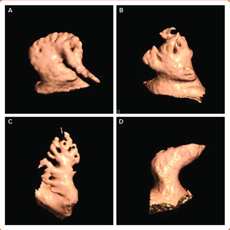 Four Different Left Atrium Appendage Morphologies As Shown By Ct Download Scientific Diagram
