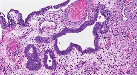 Endometrial Serous Intraepithelial Carcinoma Ottawa Atlas Of Pathology