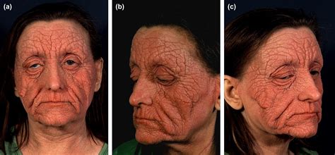 Surgical Management Of Chronic Actinic Dermatitis Journal Of Plastic