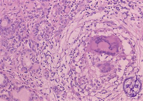 13 Endocrine 3 Subacute Thyroiditis Pathology Core Pictures