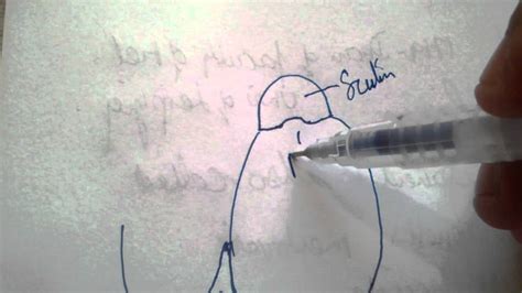 Modified Radical Mastoidectomy 3gp Youtube