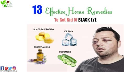 Black Eye 23 Incredible Ways To Treat A Black Eye At Home