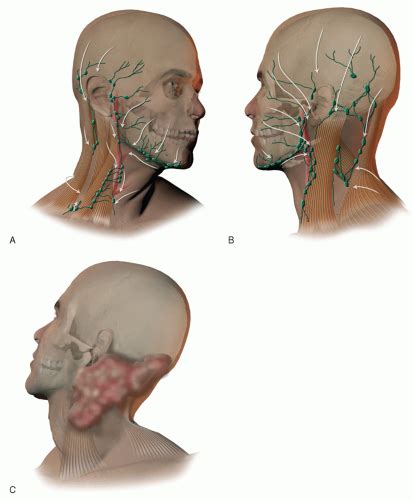 Posterolateral Neck Dissection Ento Key