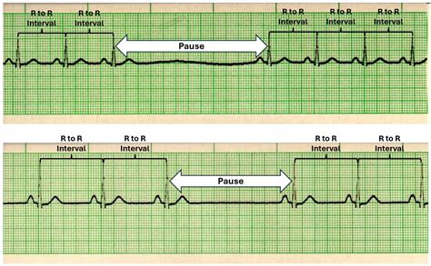Ekg Detective Sinus Arrest Vs Sinus Exit Block