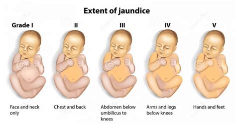 Cara Menghitung Derajat Ikterus Neonatus Kramer