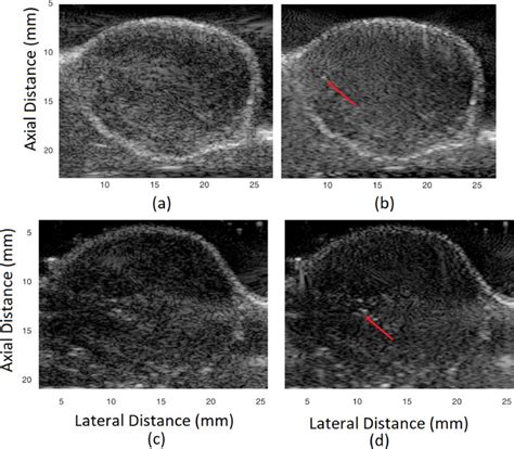 Detection Of Microcalcifications Using Nonlinear Beamforming Techniques Ultrasound In Medicine