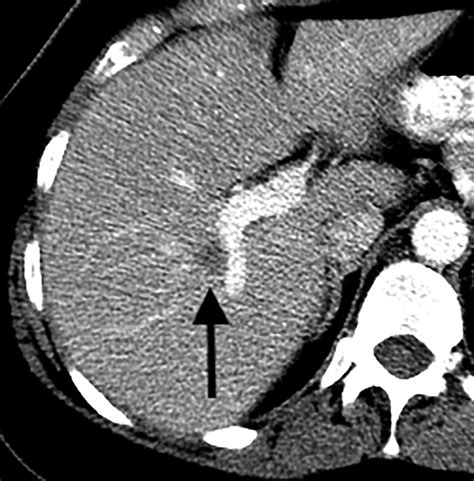 Contrast Enhanced Ct Demonstrating A 11 Cm Hypoattenuating Lesion In
