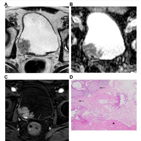 A D A 78 Yo Male With A Polypoid Lesion In Posterolateral Face Of