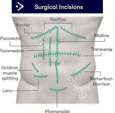 Approach To Abdominal Incisions Upper Abdominal Incision Definition