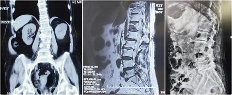 Robot Assisted Percutaneous Balloon Dilatation Of The Vertebral Body