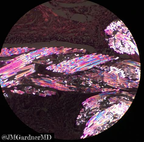 Jerad Gardner Md ‪how I Handle Nonspecific Ulcers On Biopsy To Rule