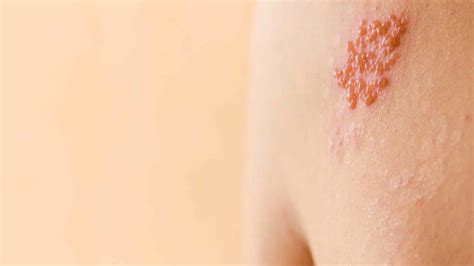 Shingles Symptoms Causes Complications And Treatment Healthshots