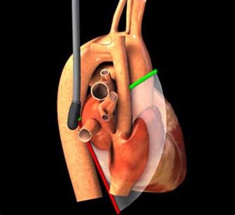 Resuscitative Tee Taking Cardiac Ultrasound To The Next Level — Kwak Talk