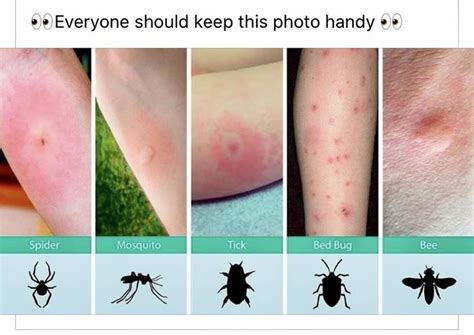 Bug Bites Simple Life Hacks Everyday Hacks Identifying Bug Bites