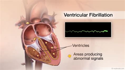How Long Does Ventricular Fibrillation Last