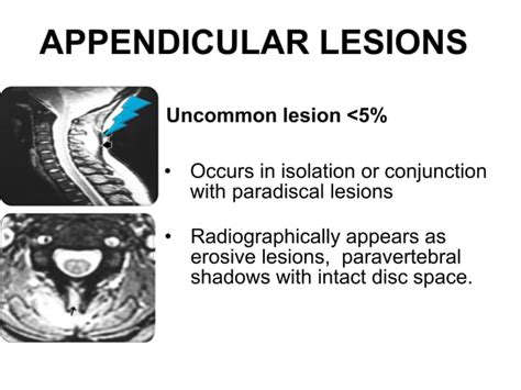 Potts Spine Tuberculosis Spine Pptx Pptx Death Injury Or
