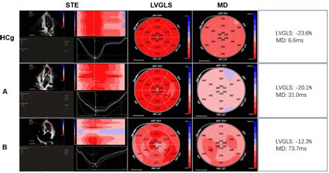 Figure 1 From Speckle Tracking Echocardiography Predicts Adverse Left Ventricular Remodeling