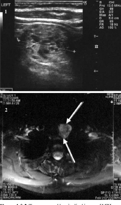 Figure 1 From Ectopic Thyroid Tissue In The Lower Neck With A