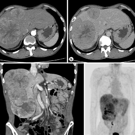 Dynamic Liver Ct A Arterial Phase Multiple Variable Sized Enhancing