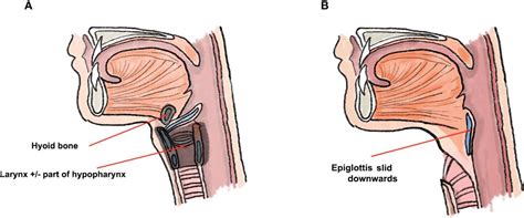 Total Laryngectomy Procedure