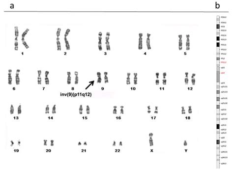 Polymorphic Rearrangements Of Human Chromosome 9 And Male Infertility