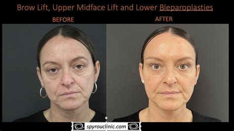 George Spyrou On Linkedin Browlift Midfacelift Blepharoplasty Cosmeticsurgery Plasticsurgery