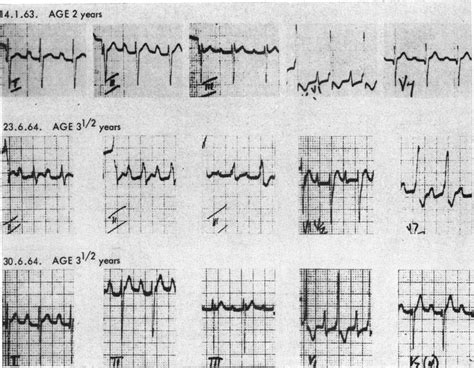 Changing Electrical Axis Associated With Alteration Of Bundle Branch Download Scientific