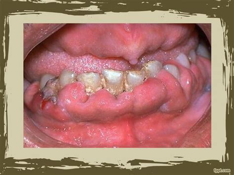 Oral Manifestation Of Leukemia Ppt