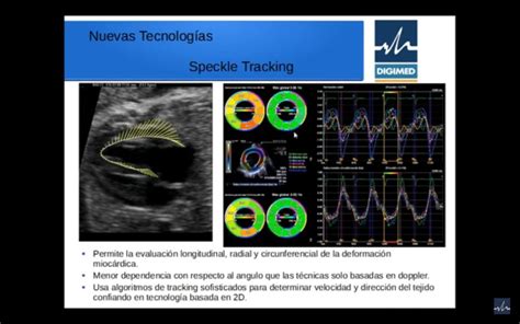 Speckle Tracking Digimed Ultrasonido