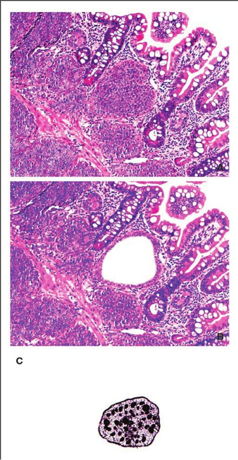 Laser Microdissection Of Carcinoid Tumor From A Patient With Multifocal Download Scientific