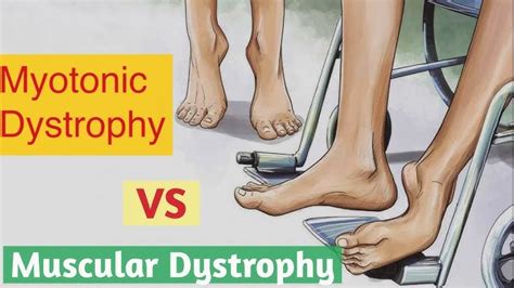 Muscular Dystrophy