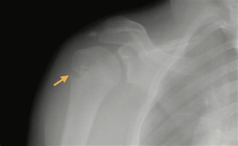 Little League Shoulder Understanding The Condition Sport Doctor London