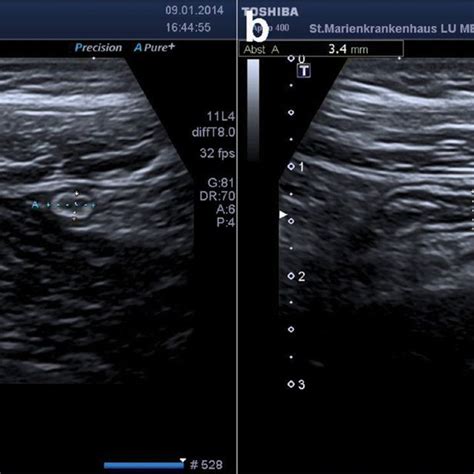 Classification Of Acute Appendicitis Caa Type 3a On Ultrasound