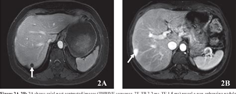 Figure 2 From Hepatic Cyst Versus Hemangioma Useful T2 Flair Image For Differentiation