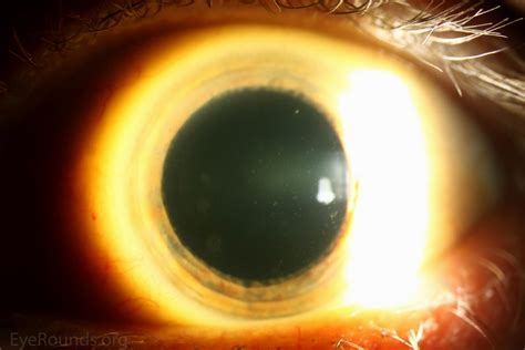 Fleck Corneal Dystrophy