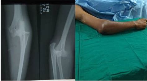 Posterior Elbow Dislocation